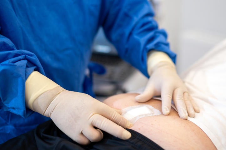 Torbiel włosowa (pilonidalna) - czy choroba przejdzie sama? - VENOMEDICA